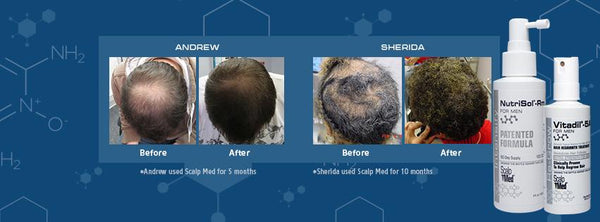 Scalp Med: Before & After Photos | ScalpMED® by REMi MEDiCAL